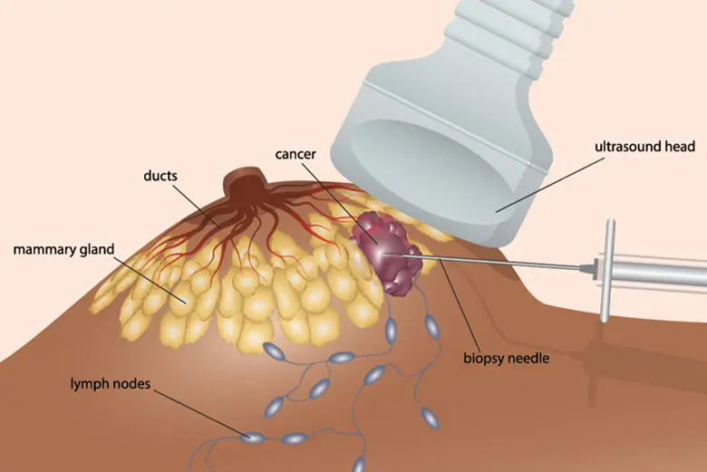 Vacuum-Assisted Biopsy Vacuum-Assisted Biopsy