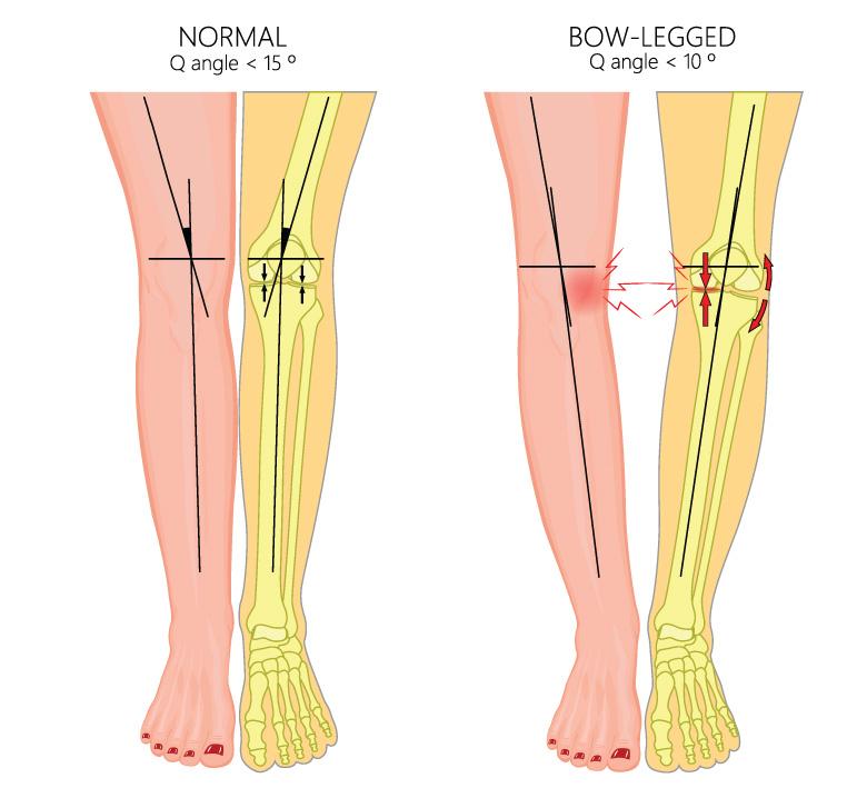 Symptoms Causes Bow Legs Genu Varum 