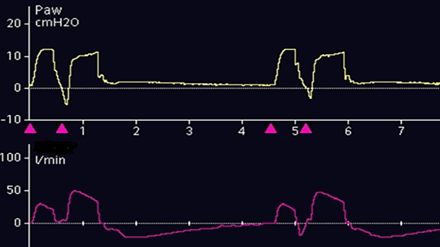 How to set expiratory trigger sensitivity (ETS) | Hamilton Medical