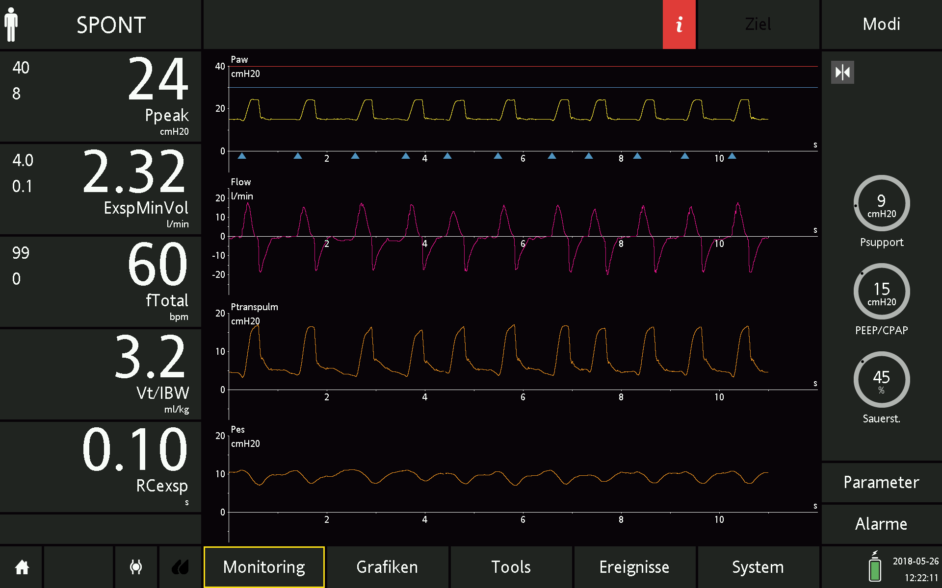 Using measured airway mechanics in pediatrics | Hamilton Medical