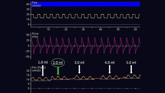 How to measure esophageal pressure correctly