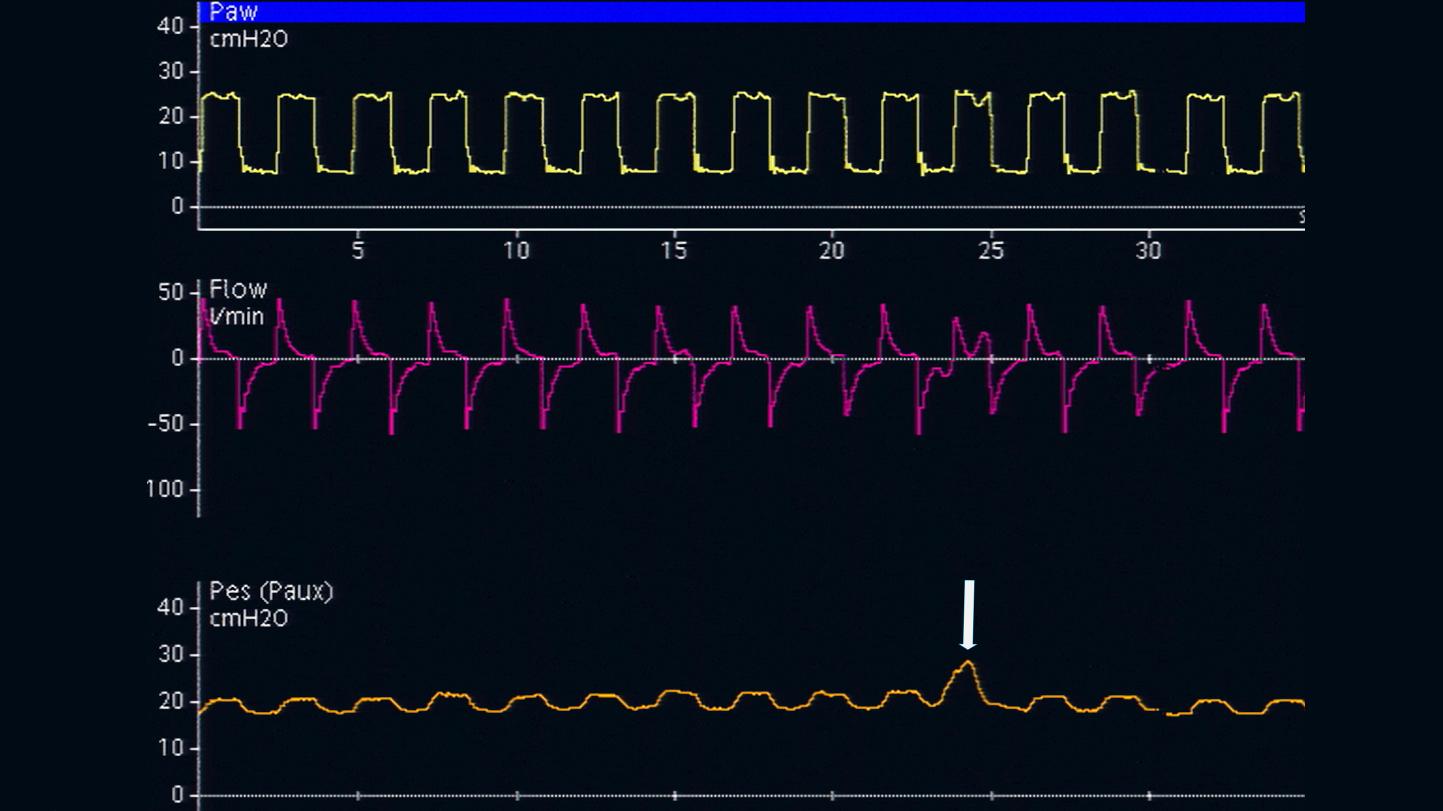 Cómo medir la presión esofágica correctamente | Hamilton Medical