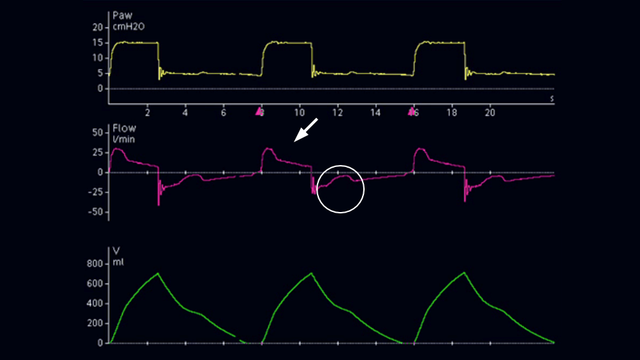 Double triggering - Diagnosis, differentiation, and resolution