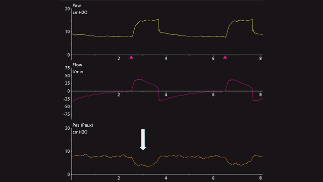 How to measure esophageal pressure correctly