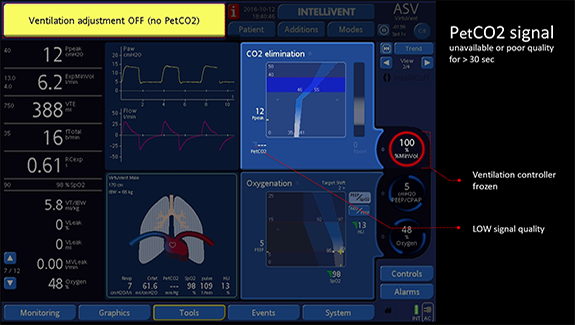 Reliability of SpO2 sensor signal readings | Hamilton Medical