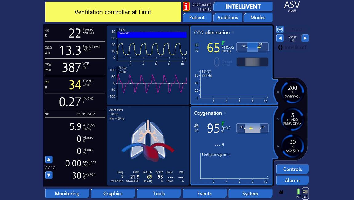 Limitation on %MinVol in INTELLiVENT®-ASV® | Hamilton Medical
