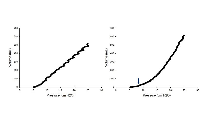Complete airway closure in ARDS patients