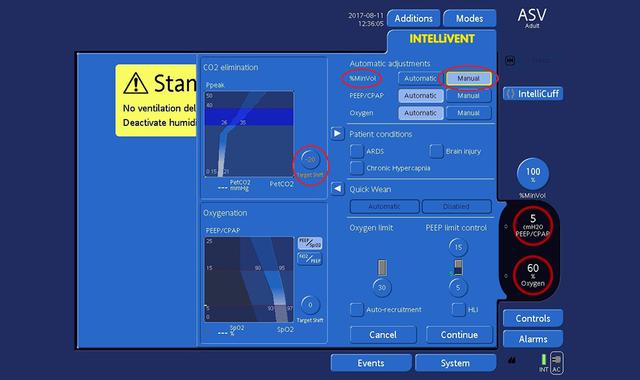 Using INTELLiVENT-ASV in patients with severe V/Q mismatch | Hamilton ...