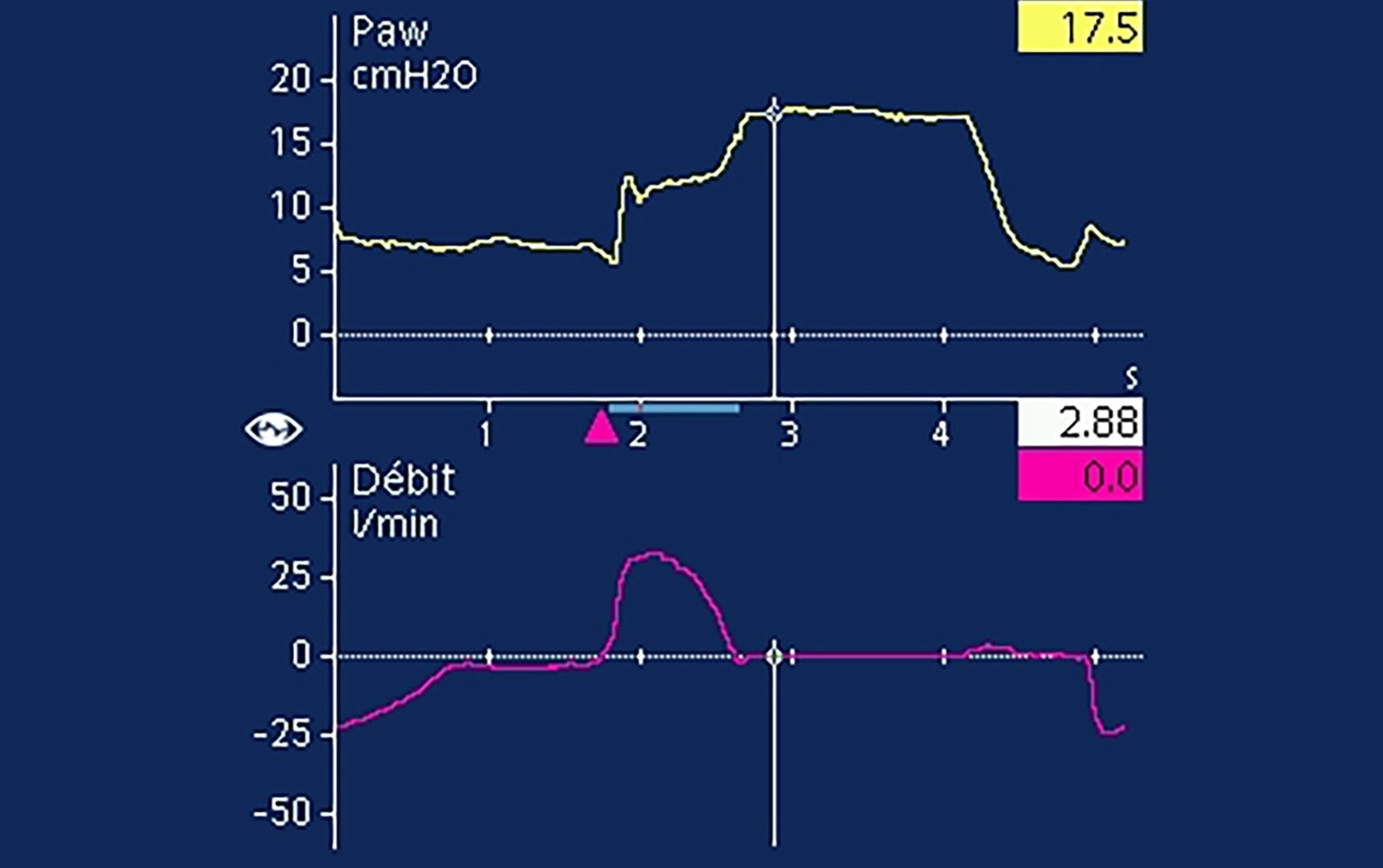 How to measure driving pressure in patients on assisted ventilation ...