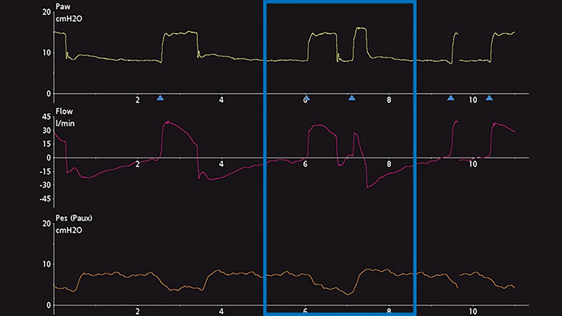 Double triggering - Diagnosis, differentiation, and resolution