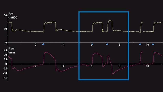 Double triggering - Diagnosis, differentiation, and resolution