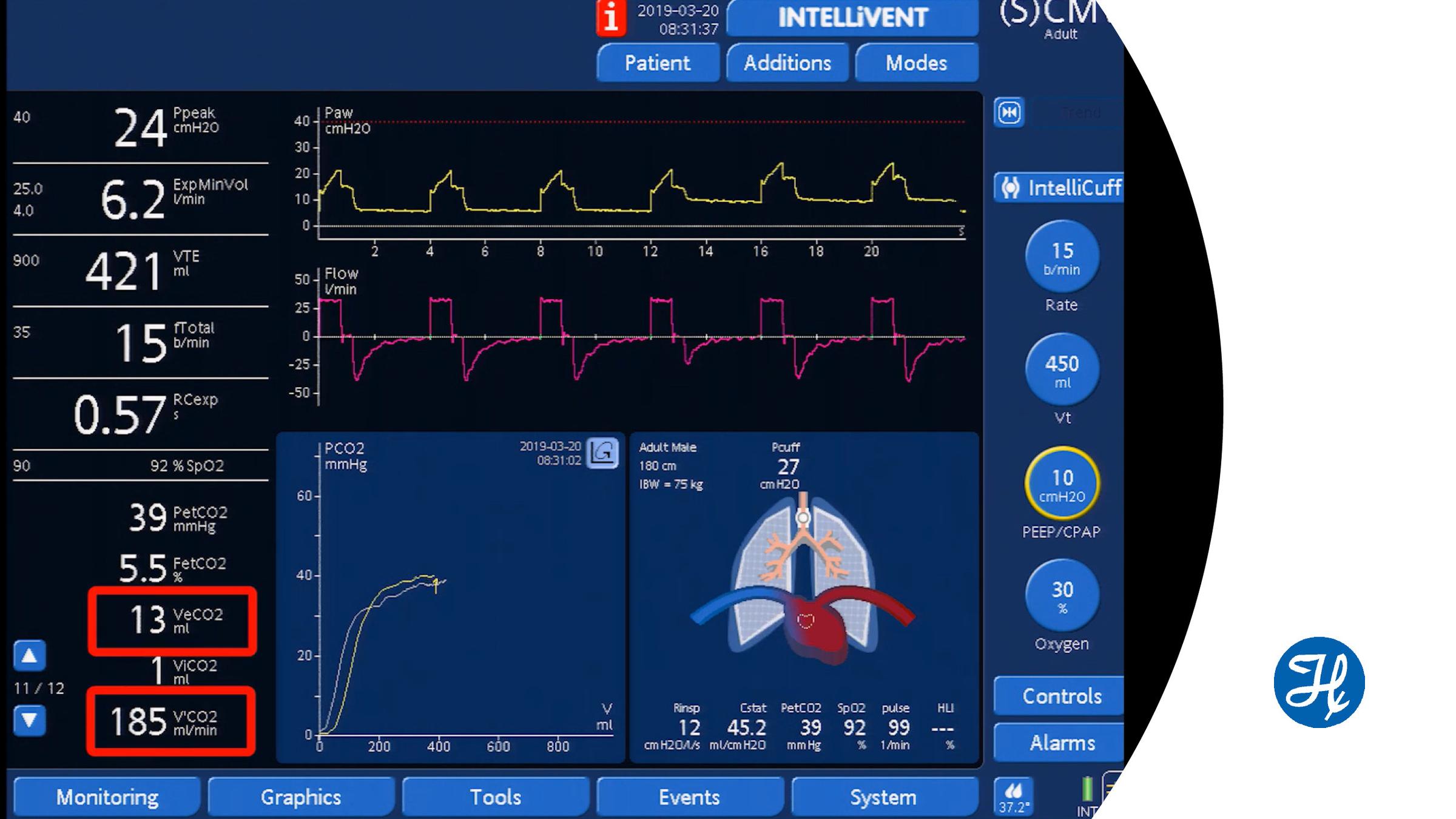 Using volumetric capnography to set PEEP | Hamilton Medical